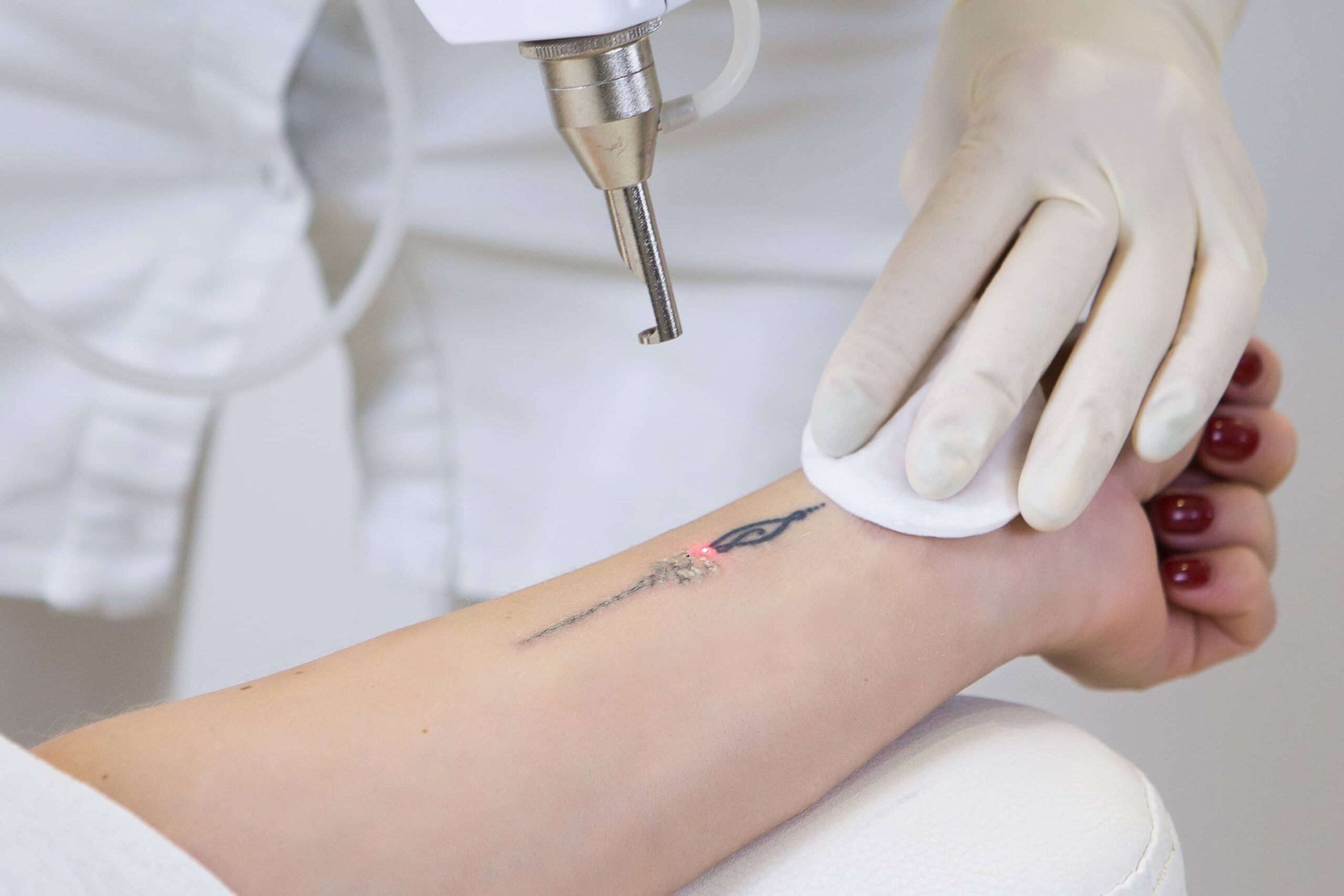 Laser Tattoo Removal Croydon | The Laser Studio